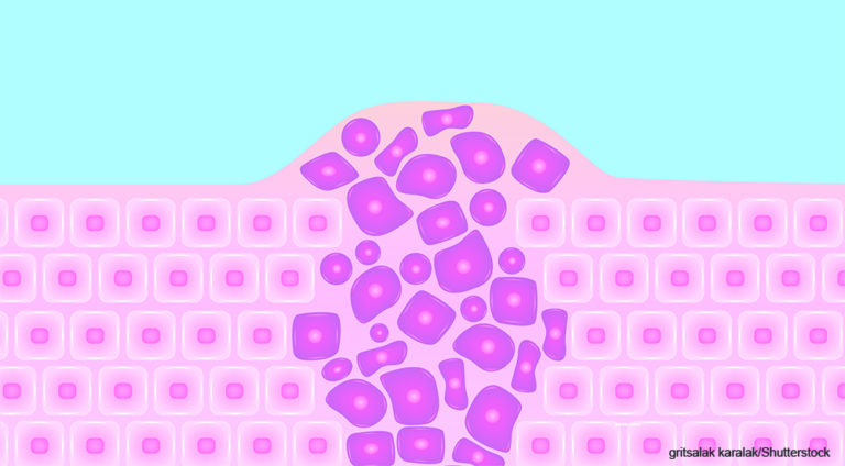 A protein that makes skin cancer cells more invasive | Hokkaido University