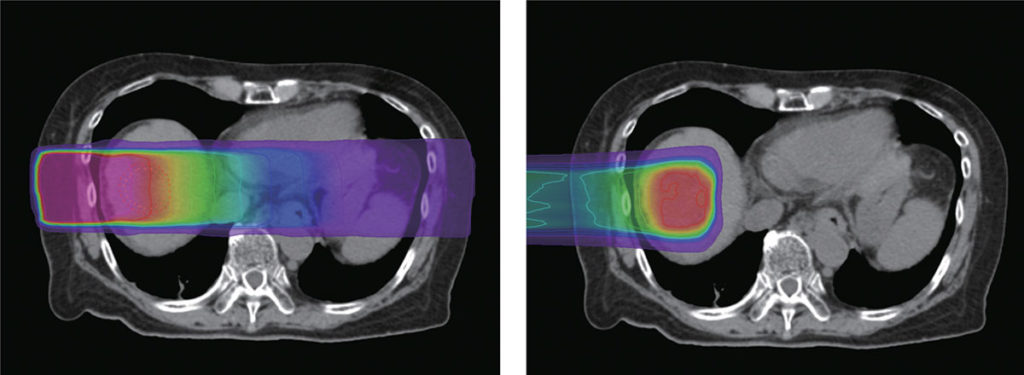 Spearheading global fight against cancer with proton therapy | Hokkaido ...